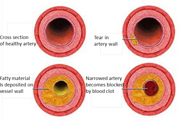 Coronary Circulation - Special Circulations - TeachMePhysiology