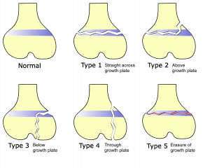 Bone Ossification - Process - Histology - TeachMePhysiology