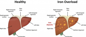 Iron Metabolism - Absorption - Excretion - TeachMePhysiology