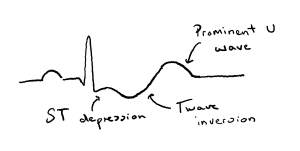 Internal Balance of Potassium - Regulation - TeachMePhysiology